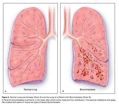 Bronchiectasis Physiopedia