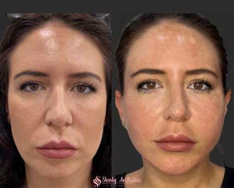 Pdo Thread Lifting Before And After Results At Skinly Aesthetics