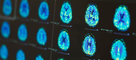 Tell Me About Mild Cortical Atrophy
