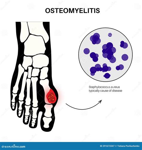 Osteomyelitis Of Arm Vector Illustration 292474070