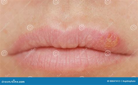 Girl Touching Sores On The Lips Herpes Lip Treatment Stock Footage Video Of Happy Burn