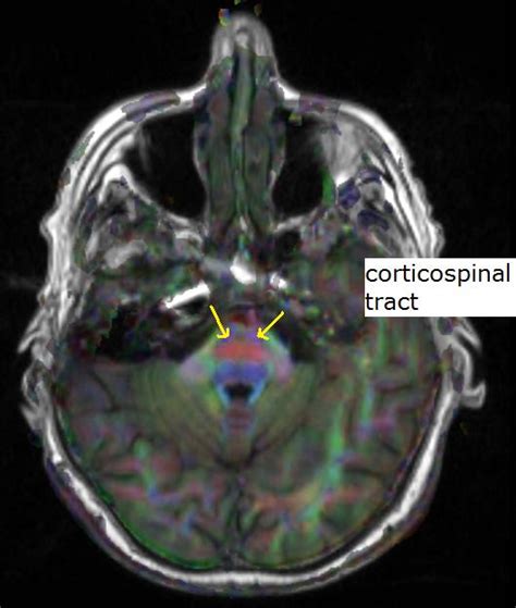 Diffusion Tensor Imaging Anatomy Sumer S Radiology Blog