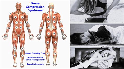 What Is Nerve Compression Syndrome Causality Care