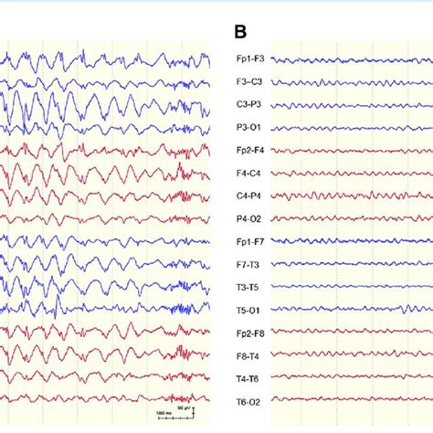 pre dbs and post dbs implantation scalp video electroencephalography