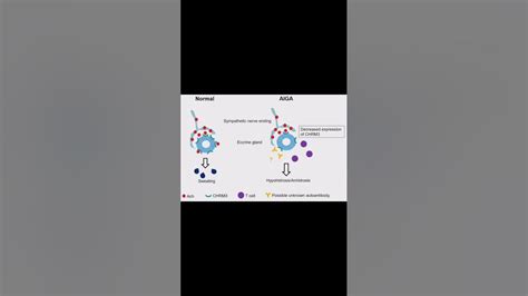 Hyperhidrosis And Anhidrosis Sweatglands Perspiration Sweatdiseases