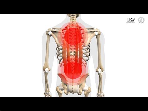 Erector Spinae Trigger Points Consequences Of Office Chair Sitting3