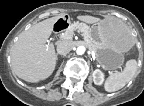 Gastrointestinal Learning Modules Ct Scanning