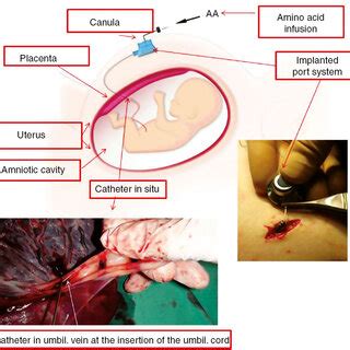 AC Dynamic Of The Pulsatility Index In The Umbilical Artery UA Download Scientific