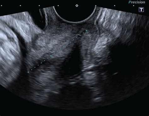 Tvu Image Of The Cervix Demonstrating A Cervix With A ‘sloped Appearance Download Scientific