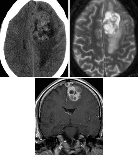 Hemangiopericytoma Radiosurgery At Victoria Dearth Blog
