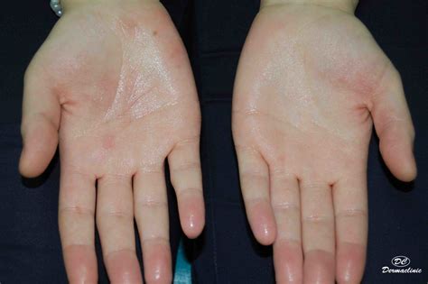 Exceso De Sudor Hiperhidrosis Dermaclinic