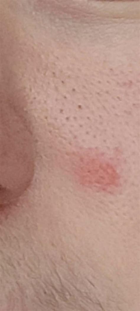 Weird Red Rash Rdermatologyquestions