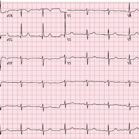 Mri Angiogram Of Upper Extremity Dvt 14 Days After Receipt Of Second