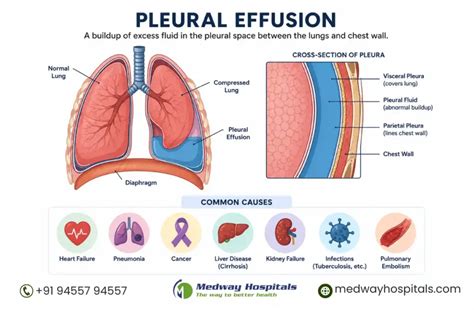 What Causes Fluid Around The Lungs 7 Warning Signs