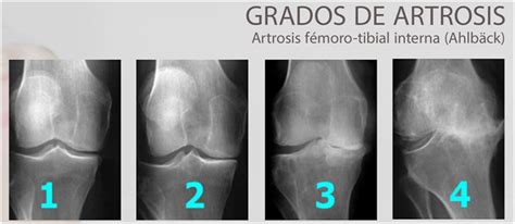 Tratamiento Artrosis Rodilla Valencia Gonartrosis Grados 1 2 3 4