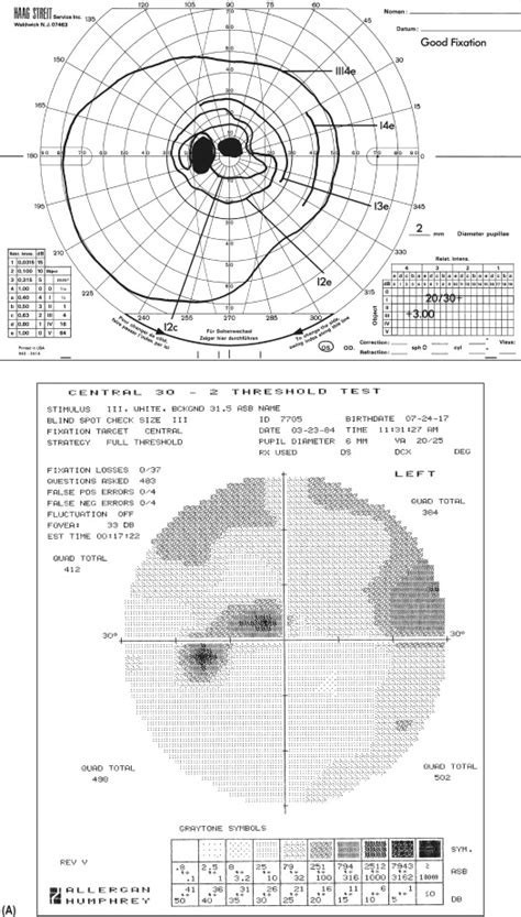 Visual Field Interpretation Ento Key