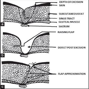 Karydakis Flap