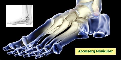Accessory Navicular Symptoms Causes And Treatment Pune Foot Ankle