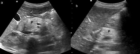 Acute Pancreatitis In Pancreatic Insufficient Cystic Fibrosis Patients