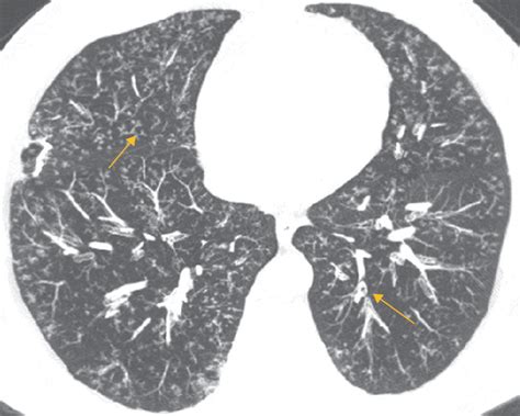 Axial Computed Tomography Scan Demonstrating Classic Findings Of
