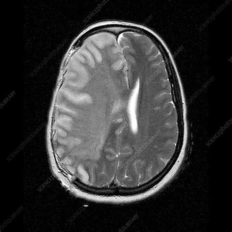 Stroke Mri Scan Stock Image M1360295 Science Photo Library