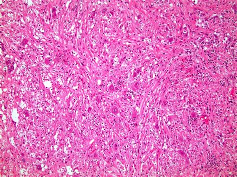 Pathology Outlines Pheochromocytoma