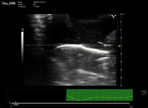 Tumor Ultrasound Instance Segmentation Dataset And Pre Trained Model By