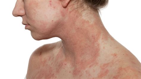 In Ad Trial Abrocitinib Relieves Itch Faster Than Dupilumab