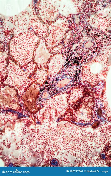 Tuberculosis Tissue Stock Image Image Of Small Pathoogy 196727361