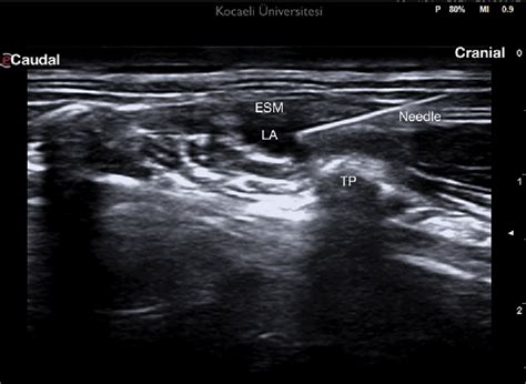 Figure 1 From Ultrasound Guided Erector Spinae Block For Postoperative