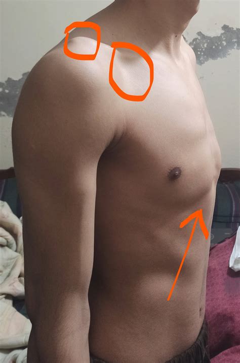 How To Get Rid Off From Pectus Carinatum Aka Pigeon Chest Through Diet