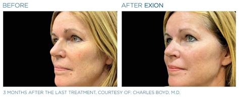 Aesthetic Treatments Vero Beach Botox Port St Lucie