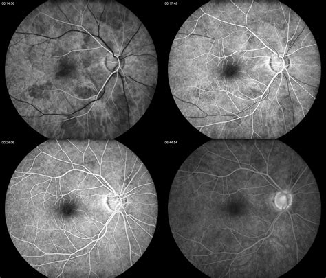 Macular Edema Fluorescein Angiography