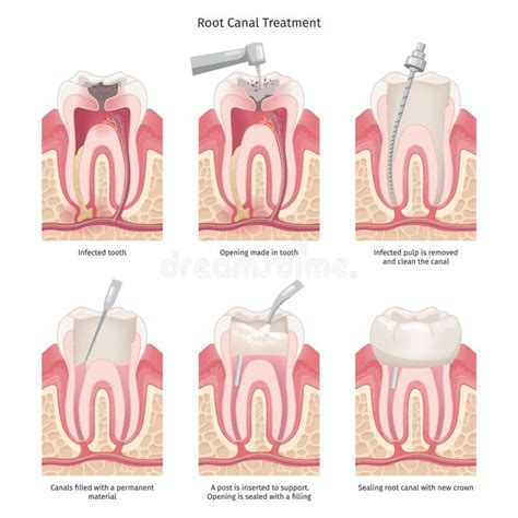 Root Canal Treatment Tooth Canal Rooth Filling Endodontic Procedure Roots Bacteria Infection