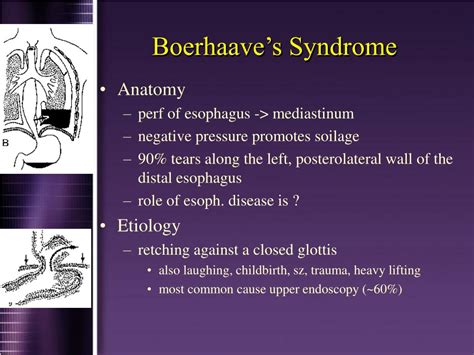 What Is Boerhaave Syndrome Esophageal Perforation Nwew