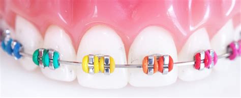 Self Ligating Braces What Are They Benefits And Costs