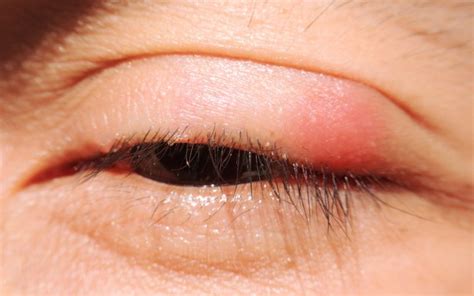 Blepharitis And Stye What Are The Differences