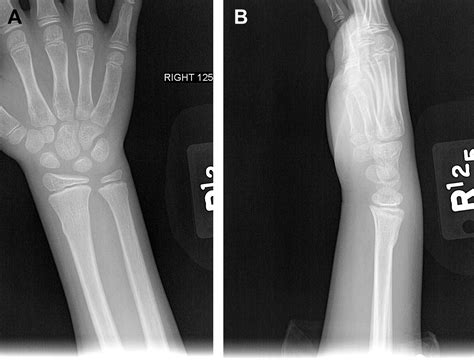Pediatric Orthopedic Emergencies Emergency Medicine Clinics