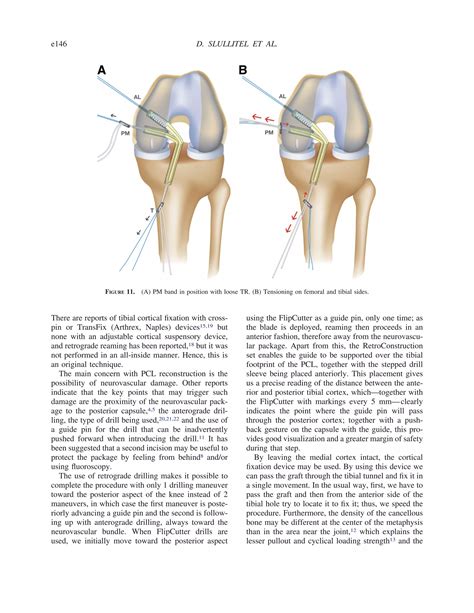 Double Bundle All Inside Posterior Cruciate Ligament Reconstruction Pdf