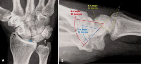 Scaphoid X Ray Angle
