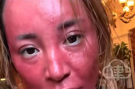 Chinese Woman Left With Inflamed Disfigured Face After Allegedly
