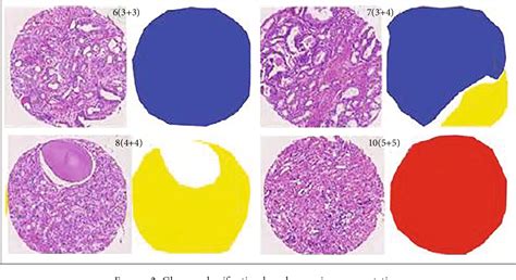 Figure 2 From Identification And Classification Of Prostate Cancer