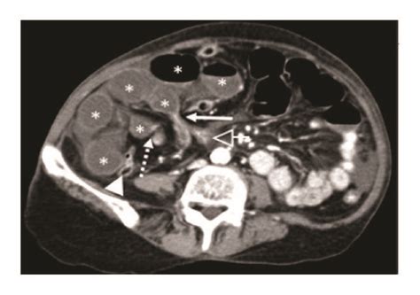 Contrast Enhanced CT Of The Abdomen And Pelvis Demonstrating Closed Download Scientific Diagram