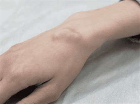 Lumps And Bumps Cause For Concern Warrenton Dermatology And Skin