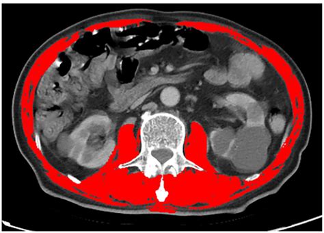 Example Of Body Composition Analysis For Measurement Of Skeletal Muscle