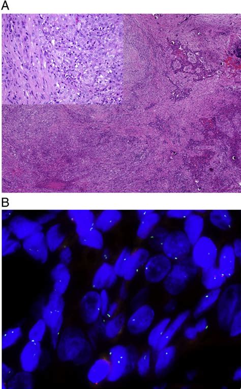 Stages Of Copd Fev1 Stages Of Copd Fev1