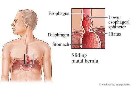 Sliding Hiatal Hernia Upmc Health Library