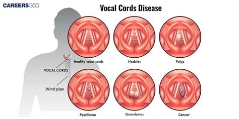 Vocal Cord The Source Of Human Voice Anatomy Function Topics