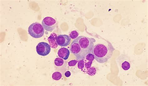 Microscopic View Of Bone Marrow Slide Showing Multiple Myeloma Also Known As Myeloma Is A Type