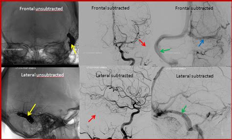 Introductory Brain Angiography